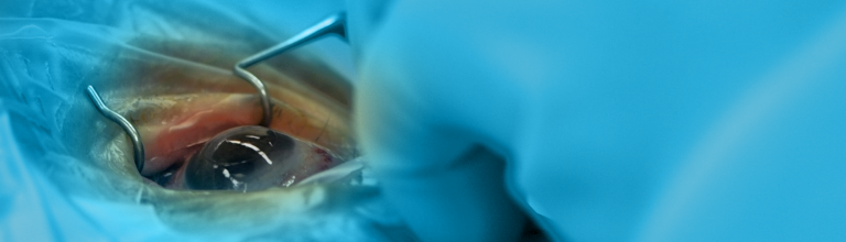 Corneal Transplant - VIP Laser Eye Center