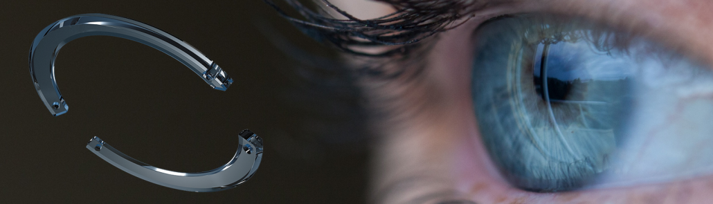 Keratoconus - VIP Laser Eye Center